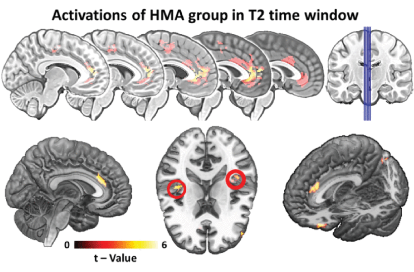 The impact of math anxiety on working memory: A cortical activations ...
